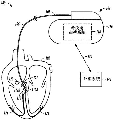 Systems For His Bundle Pacing Eureka Patsnap