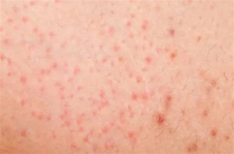 16 علت رایج لکه های قرمز بدون خارش روی پوست