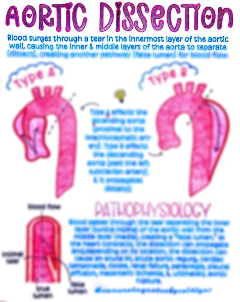 Aortic Dissection The Pathophysiology Etsy