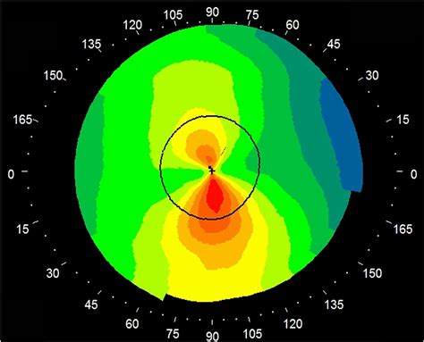 Keratoconus Topography Maps At Geraldine Edmondson Blog