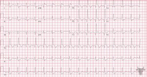St Elevation Myocardial Infarction Ecg Stampede
