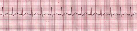Acls Megacode 7 Syncopepulseless Electrical Activity Advanced