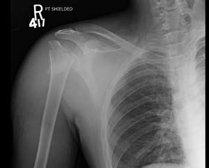Proximal Humerus Fracture WikiSM Sports Medicine Wiki