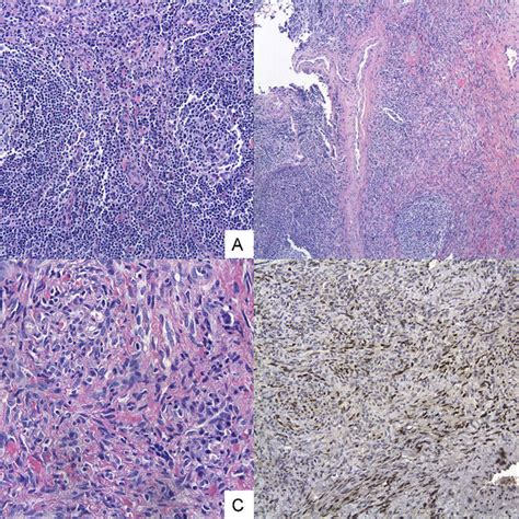 A Lymph Node With Hyalinized Germinal Centers And Expanded Mantle Download Scientific Diagram