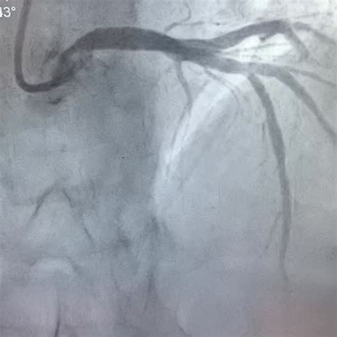 Saeed Amiripouya On Linkedin Dk Crush Lad Diagonal