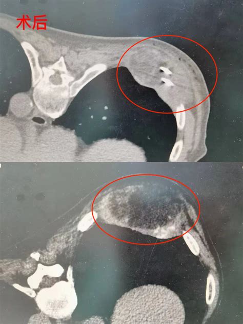【前列腺癌全身骨转移】肋骨巨型肿瘤，冷冻消融术一“消”了之！ 企业官网
