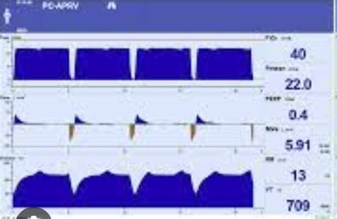 Airway Pressure Release Ventilation