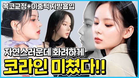 코성형 신세경 같은 코라인 예쁨주의 코수술 8달차 비포 애프터│리얼후기│버블tv Youtube