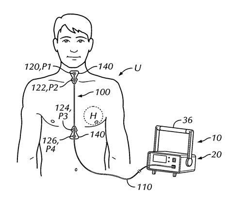 Thoracic Impedance Patented Technology Retrieval Search Results Eureka Patsnap