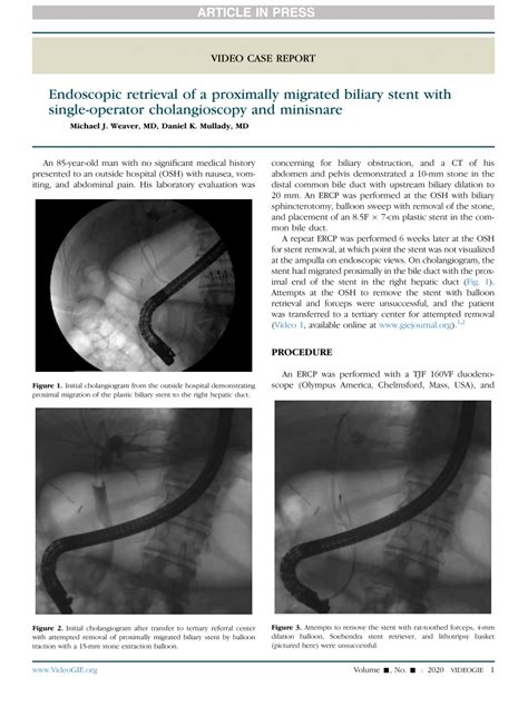 Pdf Endoscopic Retrieval Of A Proximally Migrated Biliary Stent With Single Operator