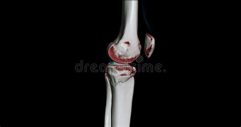 Fracture Of The Tibia Two Types Of Fracture Stock Illustration Illustration Of Element