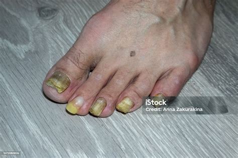 Mold On Man Foot Close Up Person With Nail Fungus Infection Broken