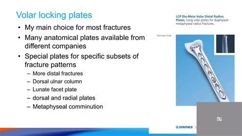 High Energy Distal Radius Fractures External Fixation Bridge Plating Or Open Reduction And