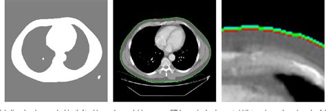 Figure 6 From Automatic Thoracic Anatomy Segmentation On Ct Images Using Hierarchical Fuzzy