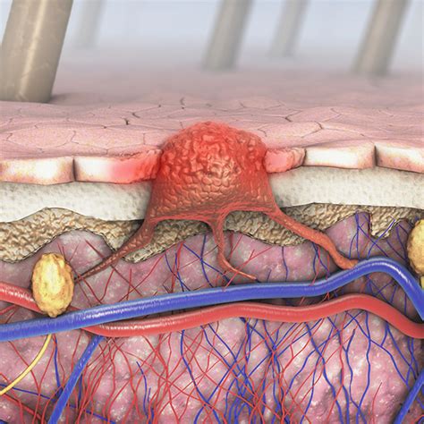Mayo Clinic Qanda Using Radiation Therapy To Treat Brain Tumors Mayo