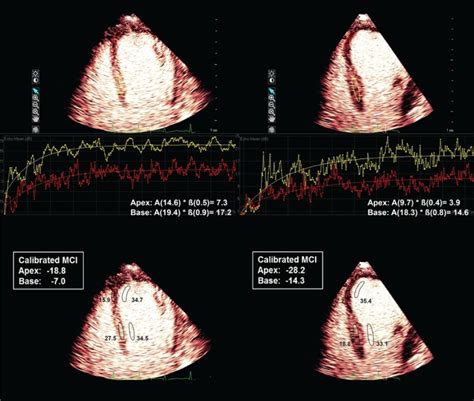 Quantitative Segmental Analysis Of Myocardial Perfusion To Differentiate Stress Cardiomyopathy
