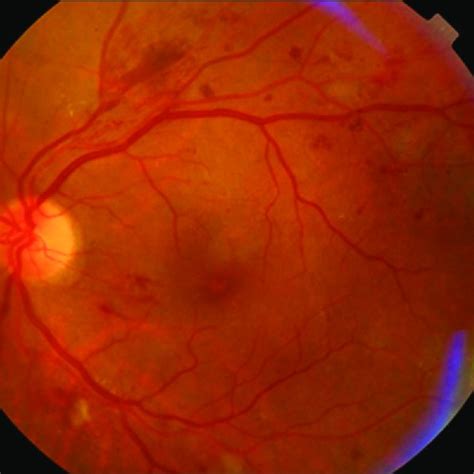 Abbreviated Summary Of Etdrs Final Retinopathy Severity Scale For Download Table