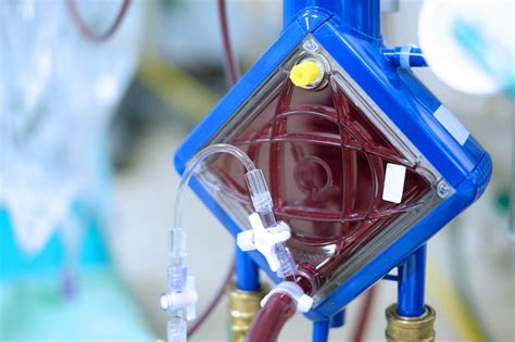 Ecmo Qué Es Cuándo Se Indica Y Cómo Funciona Tua Saúde