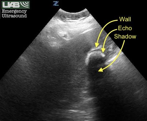Wall Echo Shadow Wes Sign Uab Emergency Ultrasound Uab Sono