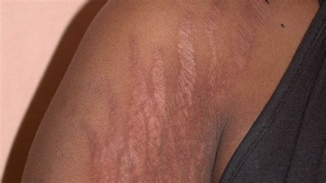 Effective Natural Ways To Remove Stretch Marks Wealth Result