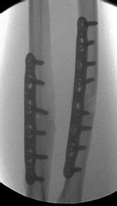 Radius Ulna Orif Expert Hand Surgeons In The East Bay