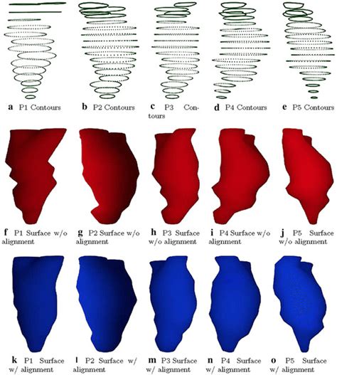 0reconstructed surface model of all subjects all patients un aligned