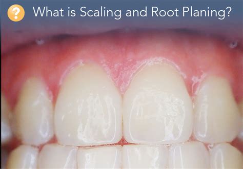 What Is Scaling And Root Planing Your Complete Guide Best Local Dentists Near Me Reviews