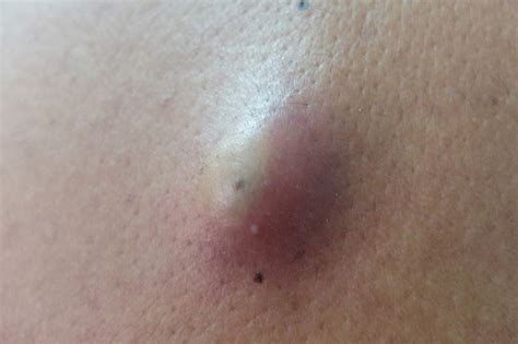 Bolitas En Los Labios Mayores 11 Causas Y Qué Hacer Con Fotos Tua