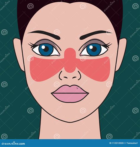 Systemic Lupus Erythematosus Cartoon Vector 63093251