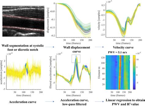 in vivo comparison of pulse wave velocity estimation based on ultrafast