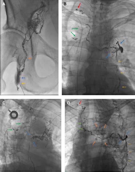 High Output Chylothorax Novel Imaging Techniques Provide Specific