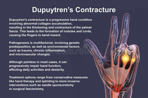 Palmar Fascia Stock Illustrations 28 Palmar Fascia Stock Illustrations Vectors And Clipart