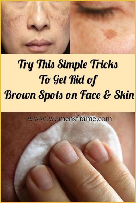 Pin By Lynda Stahl On Skin Spots On Face Brown Spots On Face Dark