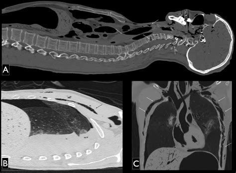 Post Mortem Ct Pmct Imaging Radiología Club