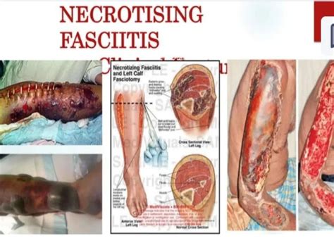 Necrotizing Facititis Pptx Necrotising Fasciitis Pptx