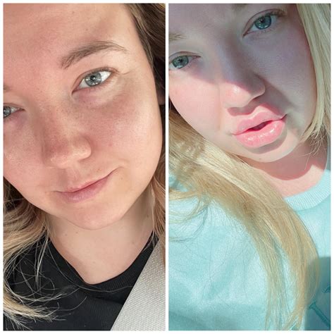 Got My 3rd Syringe Today 🙊 Quite The Before And After 💕 Rbimbofication