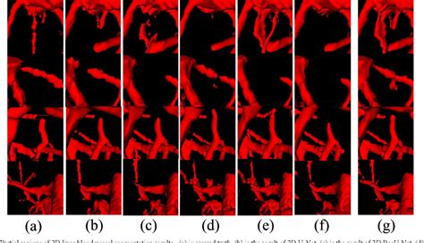 Figure 2 From 3d Cd Linknet With Cascaded Dilated Convolution For Liver Vessel Segmentation