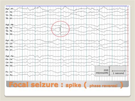 PPT Abnormal EEG Brain In Neurological Disease PowerPoint Presentation ID