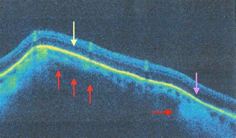 Sclerochoroidal Calcification Leads To Diagnosis Of Primary Parathyroid Cancer Published In