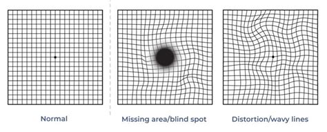 How To Use An Amsler Grid Front Range Retina