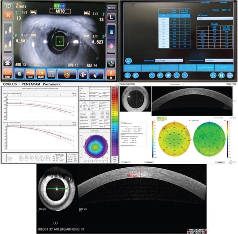 Comparison Of Central Corneal Thickness Measurements With Four