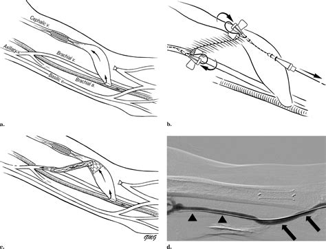 Percutaneous Creation Of A Jump Bypass Graft In A Native Arteriovenous