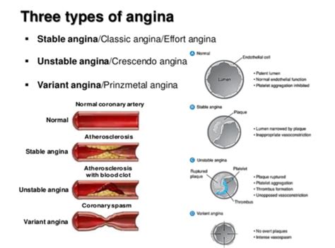 Drug Treatment Of Angina Pectoris Flashcards Quizlet