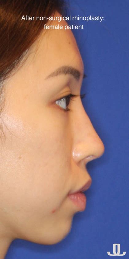 Best Non Surgical Nose Job Nyc Dr Jennifer Levine