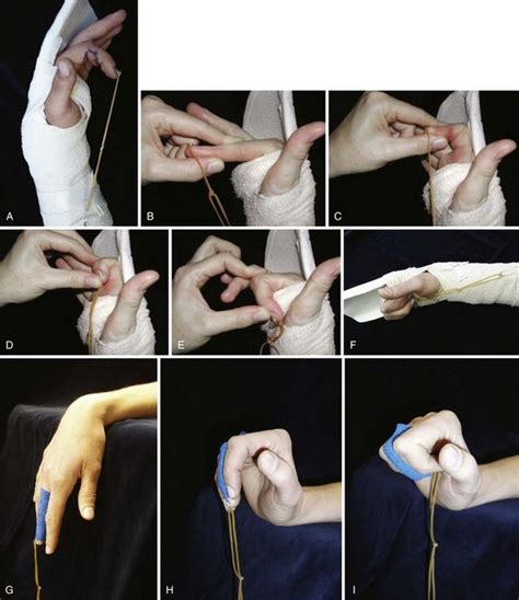 Hand Exercises After Flexor Tendon Repair At Roy Bush Blog