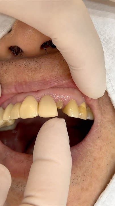 앞니임플란트 당일임시치아 Dental Dentist Dentalclinic Dentalimplants Modernimplant Youtube