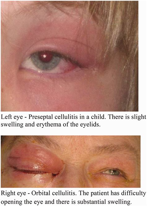 Eye Orbital Cellulitis
