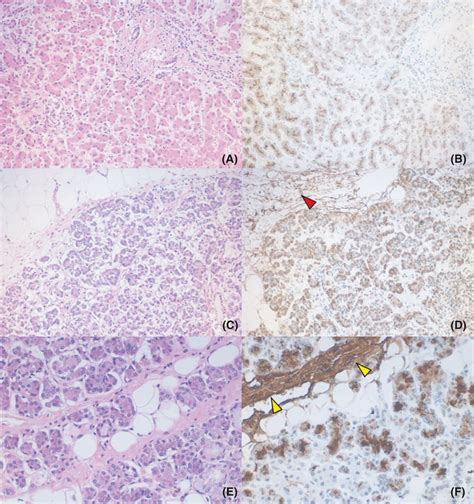 Accelerated Production Of Serum Amyloid A1 Saa1 By The Stimulated