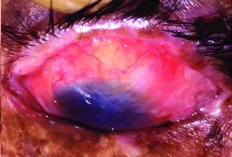 Left Eye Lesion After 2 Months Of Use Of Interferon Eyedrops Download Scientific Diagram