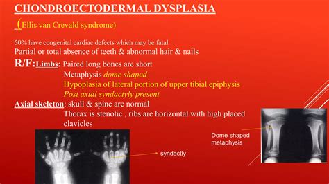 Skeletal Dysplasia Radiodiagnosis By Abhijit R Singh Pptx